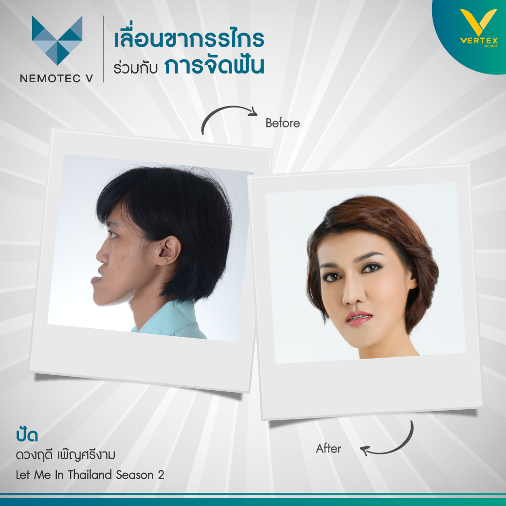 Nemotec V คืออะไร คอมพิวเตอร์ 3 มิติ การผ่าตัด เครื่องมือแพทย์, 3D