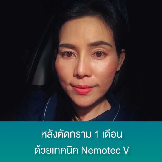 ตัดกราม เหลากราม ศัลยกรรมกราม ด้วย เทคนิค Nemotec V