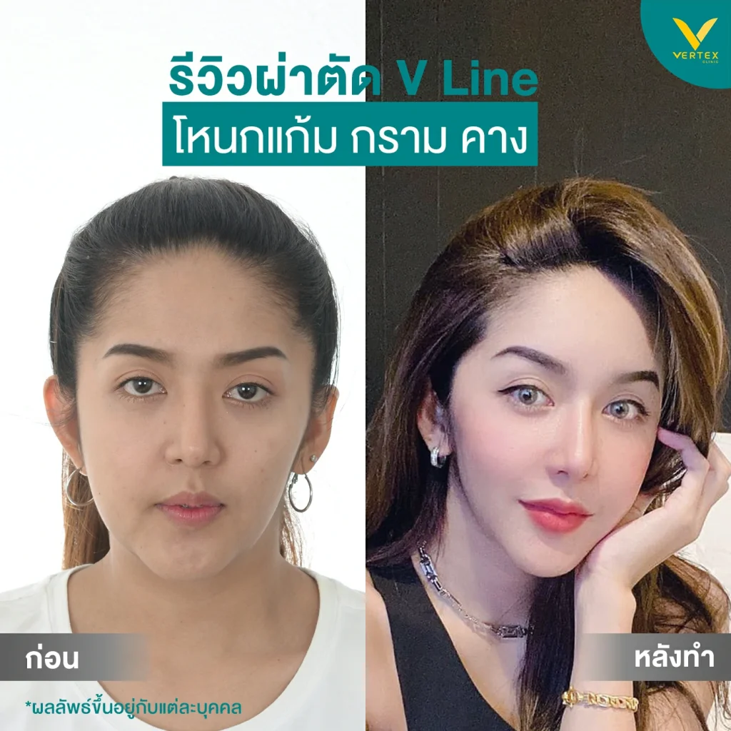 Before & After วีไลน์ (V-line) Vertex Clinic