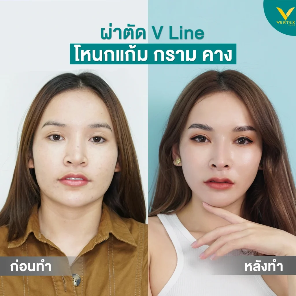 Before & After วีไลน์ (V-line) Vertex Clinic