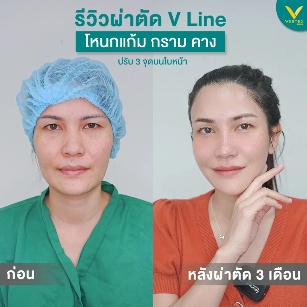 Before & After วีไลน์ (V-line) Vertex Clinic