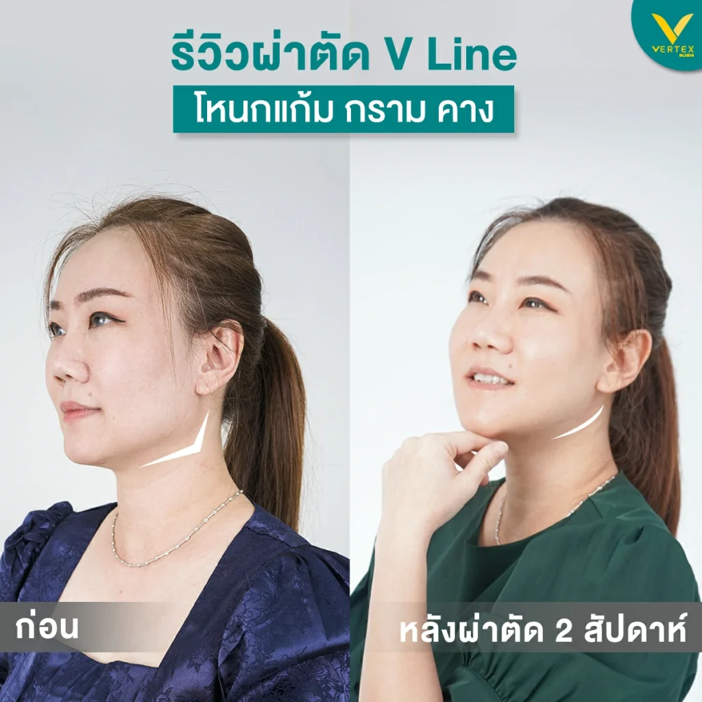 Before & After วีไลน์ (V-line) Vertex Clinic